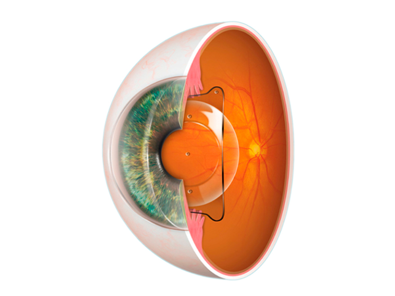 Lentes intraoculares: ¿Qué son y para quién están indicados? – Cedco
